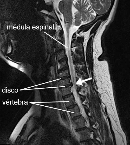Radiculopatía cervical | Causa, síntomas y tratamiento