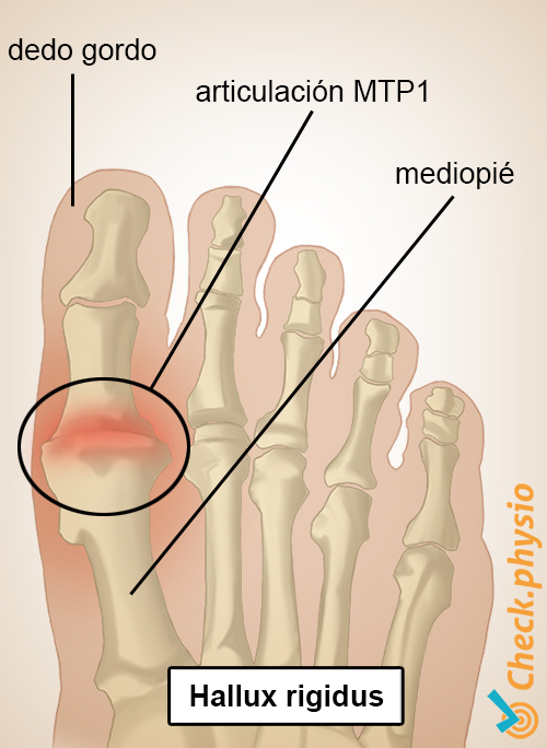 Causa, síntomas y tratamiento | Hallux rigidus - Physiocheck.hn